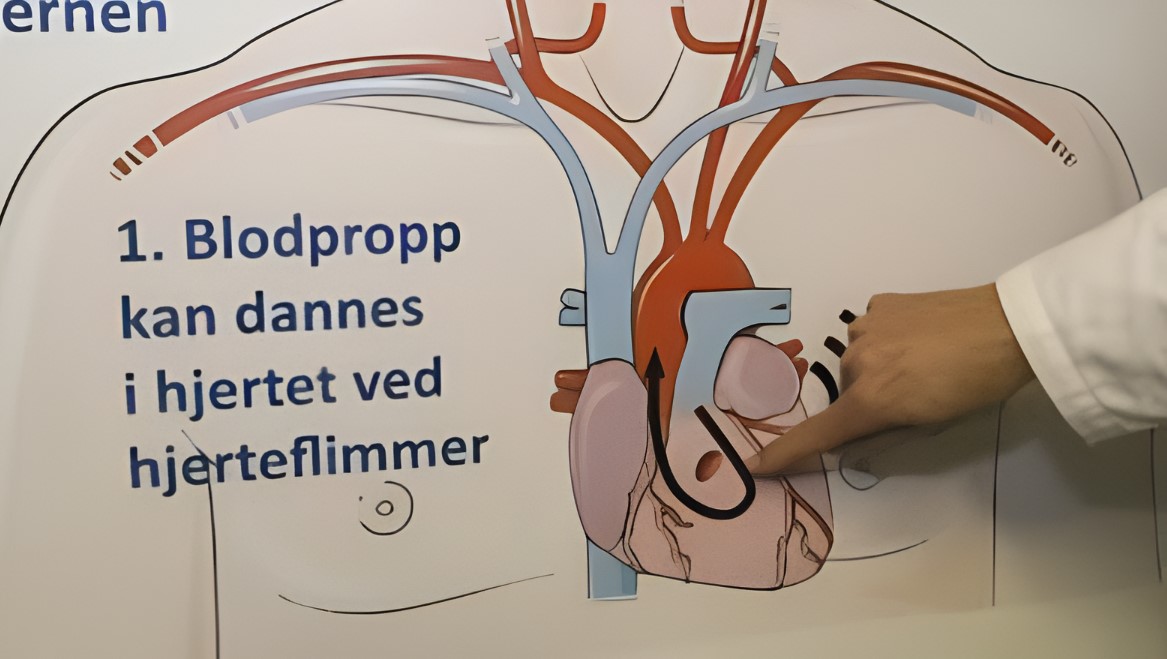 Hjerteflimmer behandling: Diagnose og medisiner